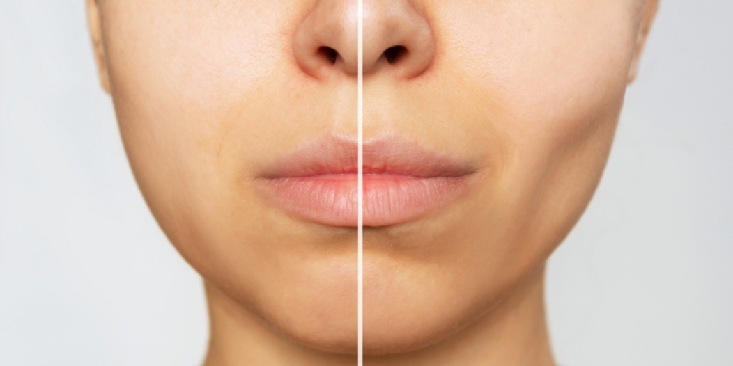 Fat Cheeks Removal: What are the Best Non-Surgical Treatments? - Simply ...
